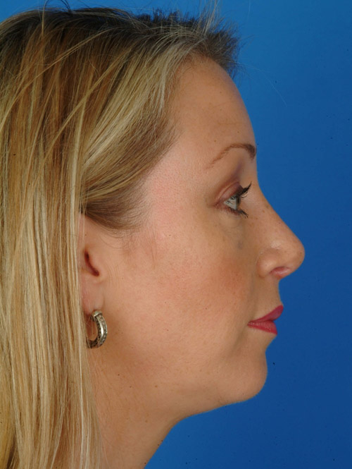 Before and After Rhinoplasty Photo Gallery | Houston, TX | Facial ...