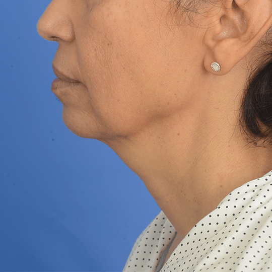 Lower face rejuvenation to correct poor jawline definition and loose ...