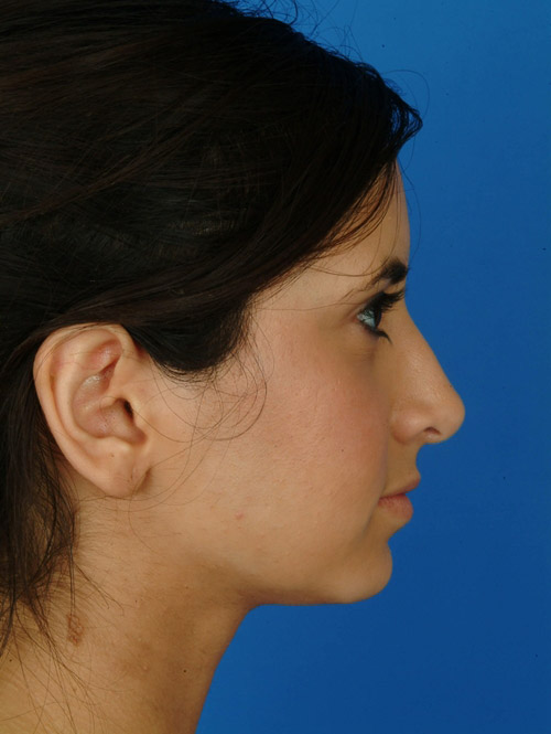 Before and After Rhinoplasty Photo Gallery | Houston, TX | Facial ...