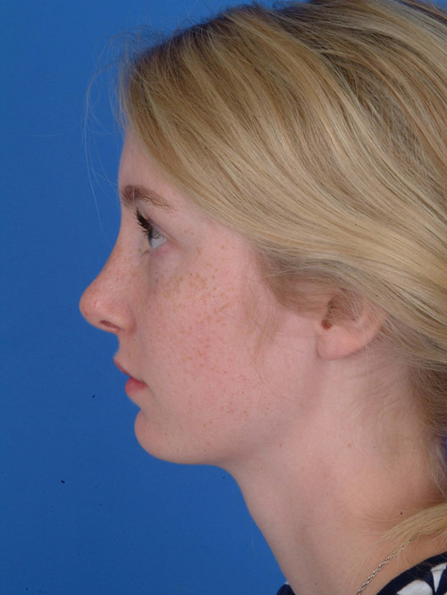 Before and After Septoplasty Photo Gallery | Houston, TX | Facial ...