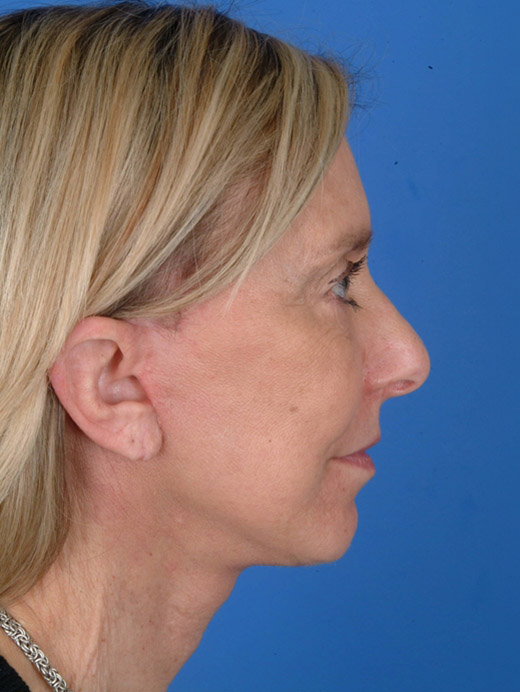 Before and After Facelift Photo Gallery | Houston, TX | Facial Plastic ...