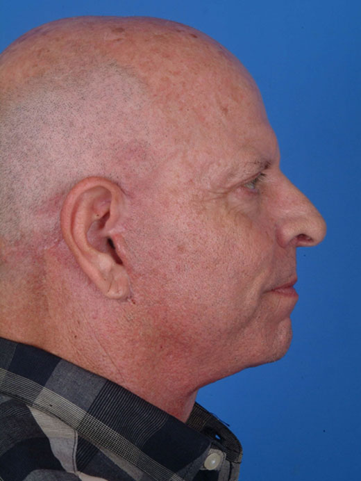 Before and After Facelift Photo Gallery | Houston, TX | Facial Plastic ...