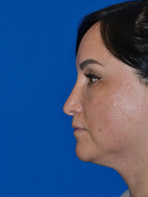Revision rhinoplasty to lift nasal tip in Houston, Texas - Facial ...