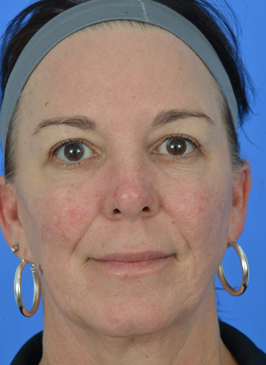 Before and After Facial Fat Transfer Photo Gallery | Houston, TX ...